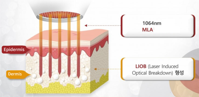 LucasPlus - Bionics Medical – Redefining Aesthetic & Dermatological ...