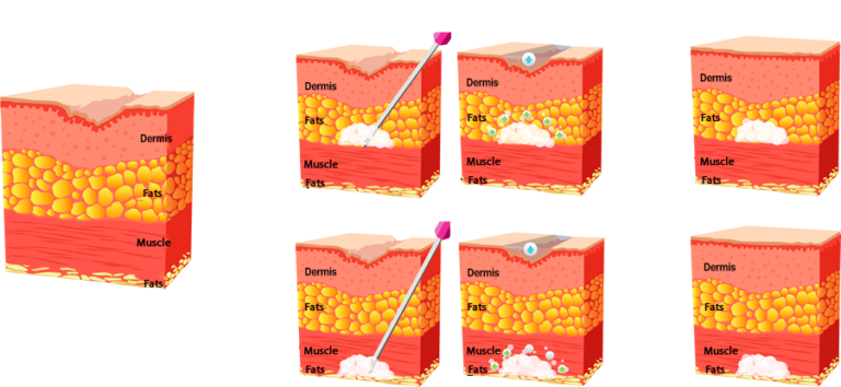 Olidia Collagen Stimulator - Bionics Medical – Redefining Aesthetic ...